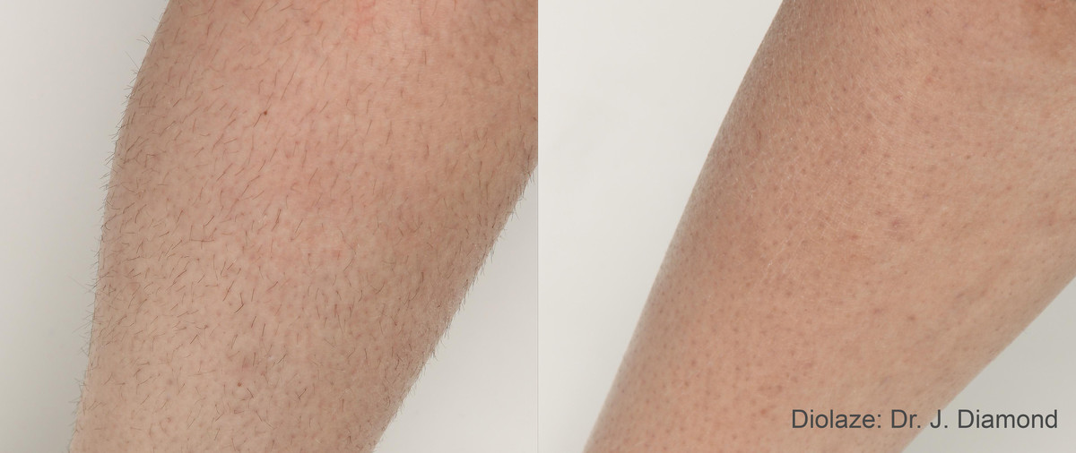Laser Hair Removal | Services | Ohana Health